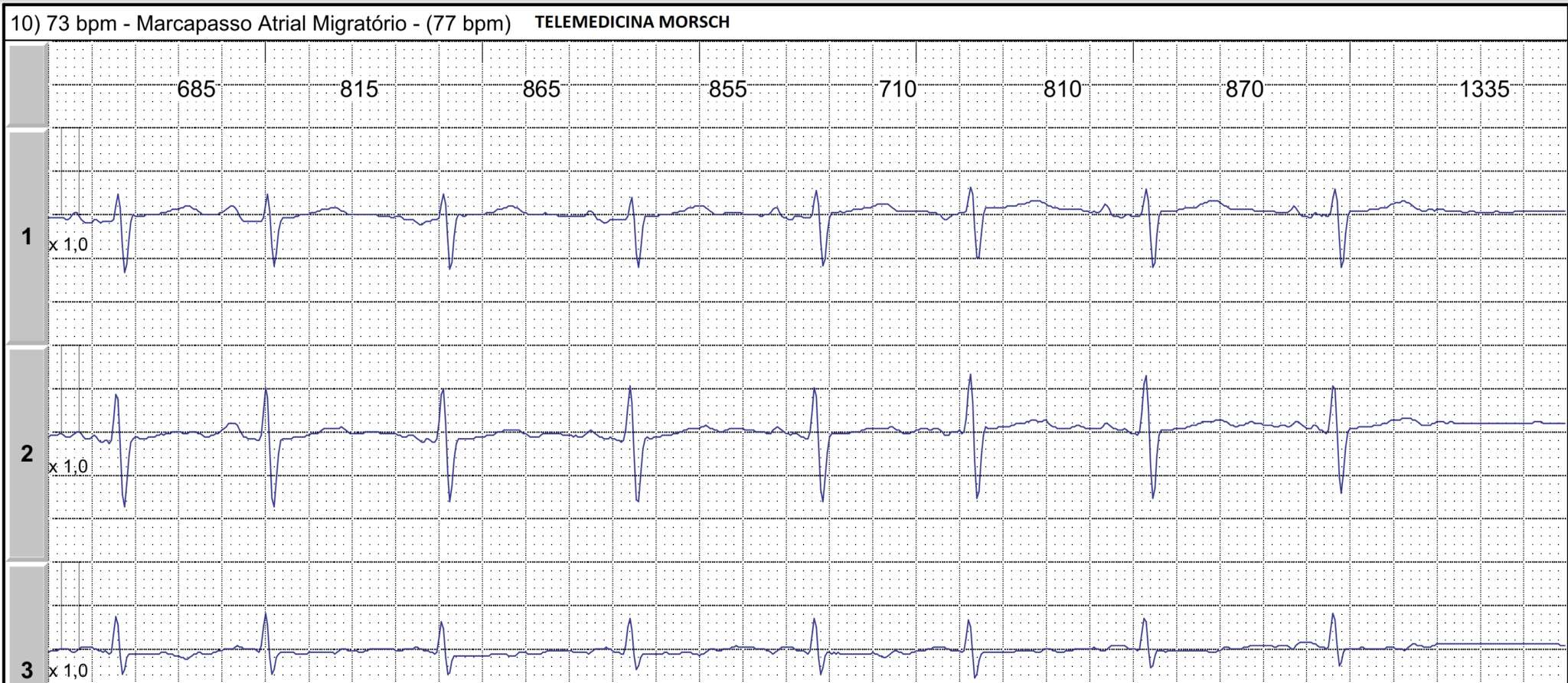 Como interpretar resultados do Holter 24 horas: exame normal e anormal