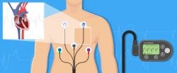 Como interpretar resultados do Holter 24 horas: exame normal e anormal