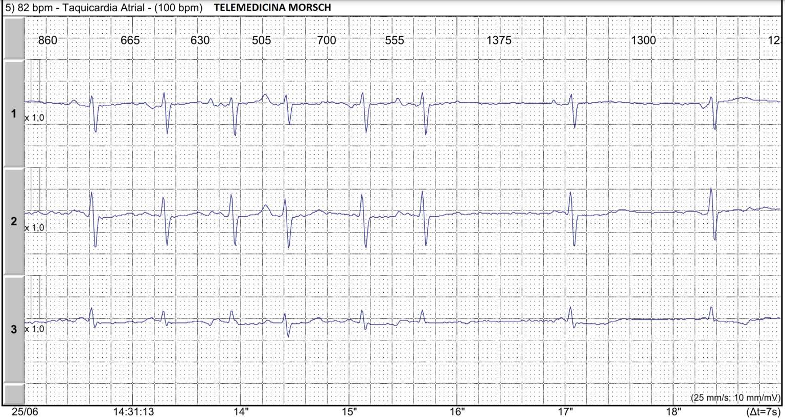 Como interpretar resultados do Holter 24 horas: exame normal e anormal