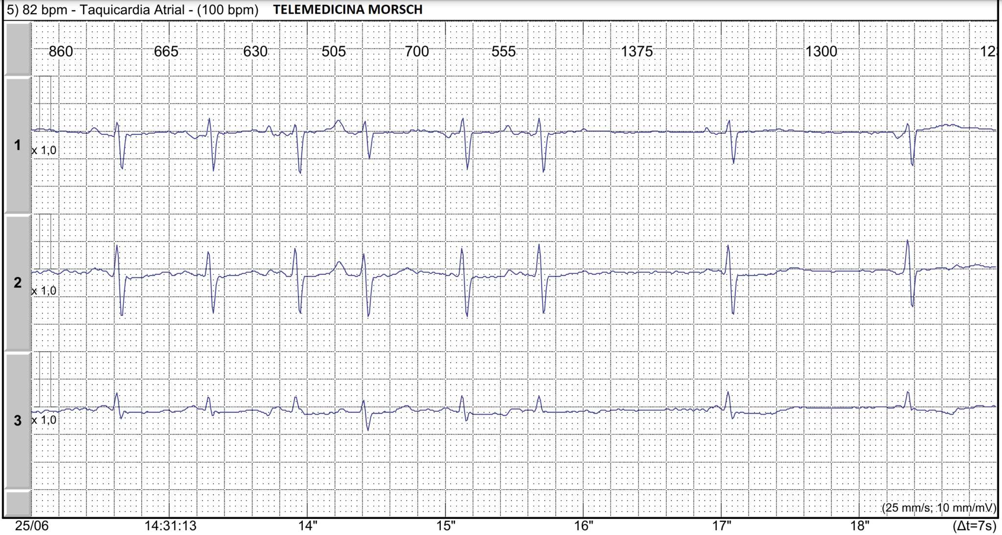 Como interpretar resultados do Holter 24 horas: exame normal e anormal