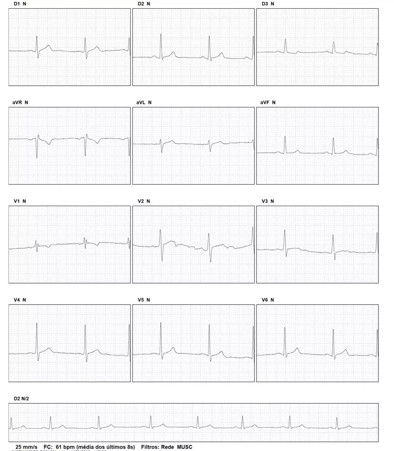 Ritmo sinusal no ECG: o que significa esse achado?