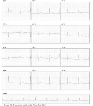 Ritmo sinusal no ECG: o que significa esse achado?
