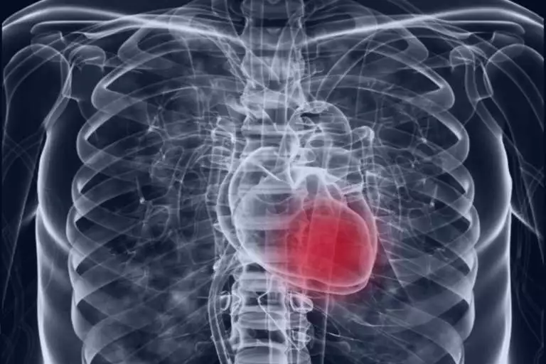 Dor precordial típica e atípica: veja principais causas