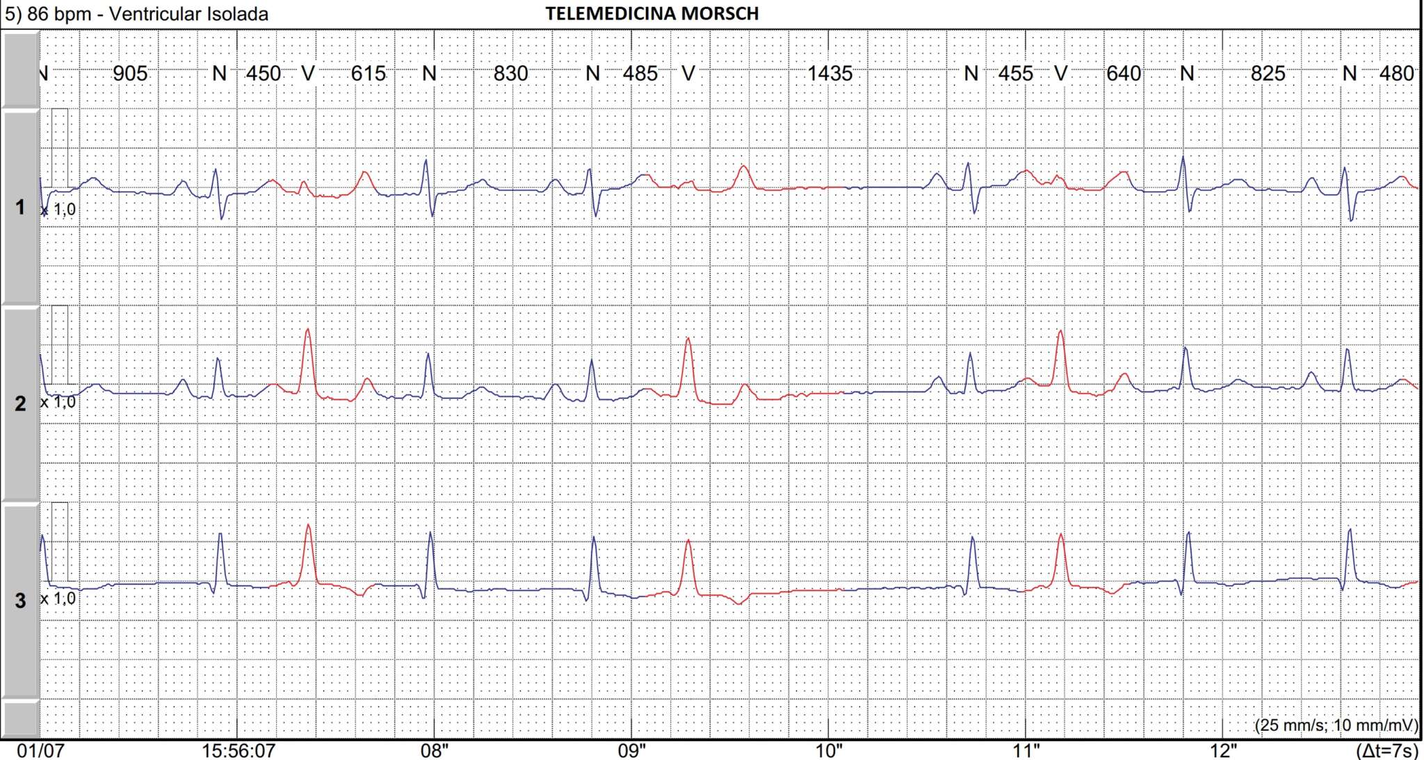 O que são extrassístoles ventriculares e supraventriculares
