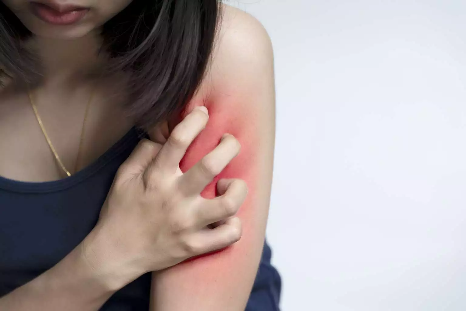 Micose de pele: principais causas, sintomas e tratamento