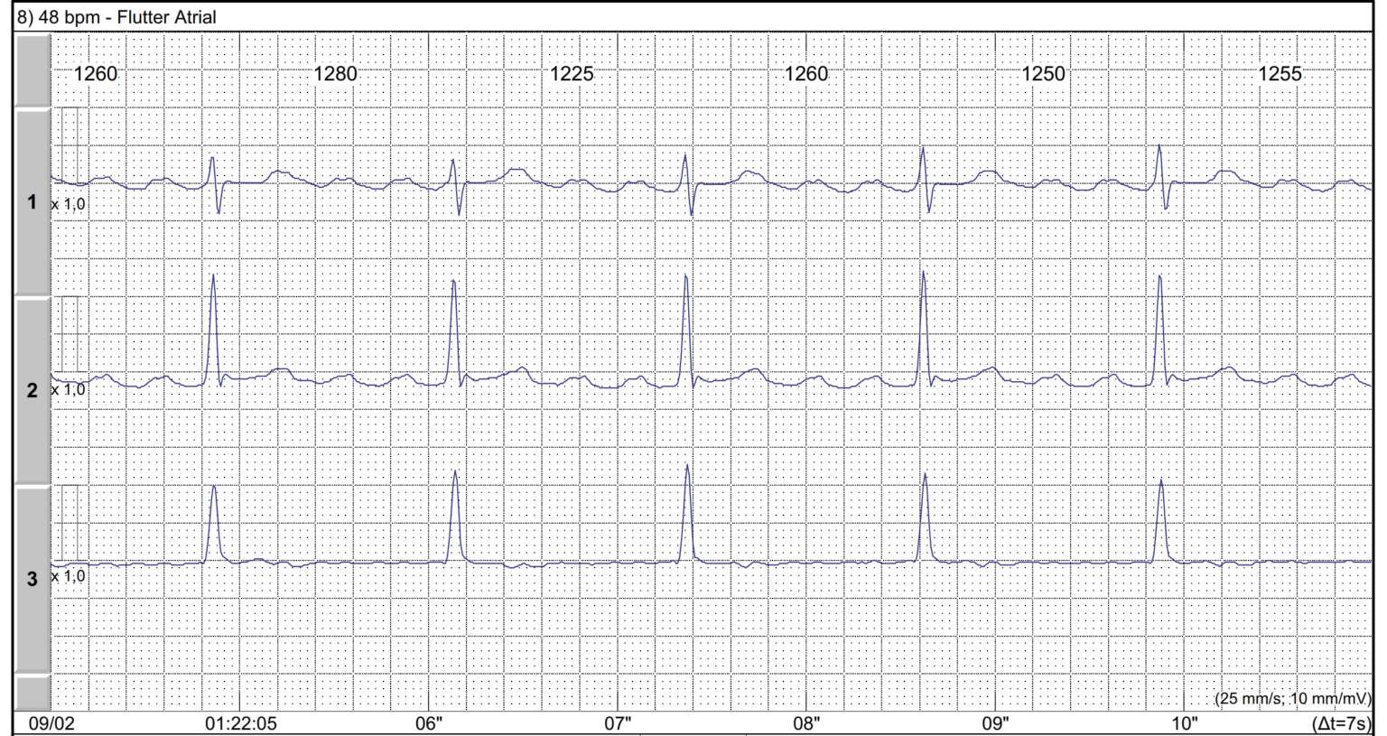 Fibrilação atrial no ECG: principais pontos de atenção