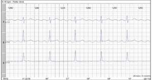 Fibrilação atrial no ECG: principais pontos de atenção