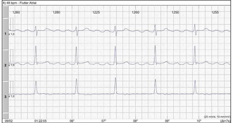 Fibrilação atrial no ECG: principais pontos de atenção