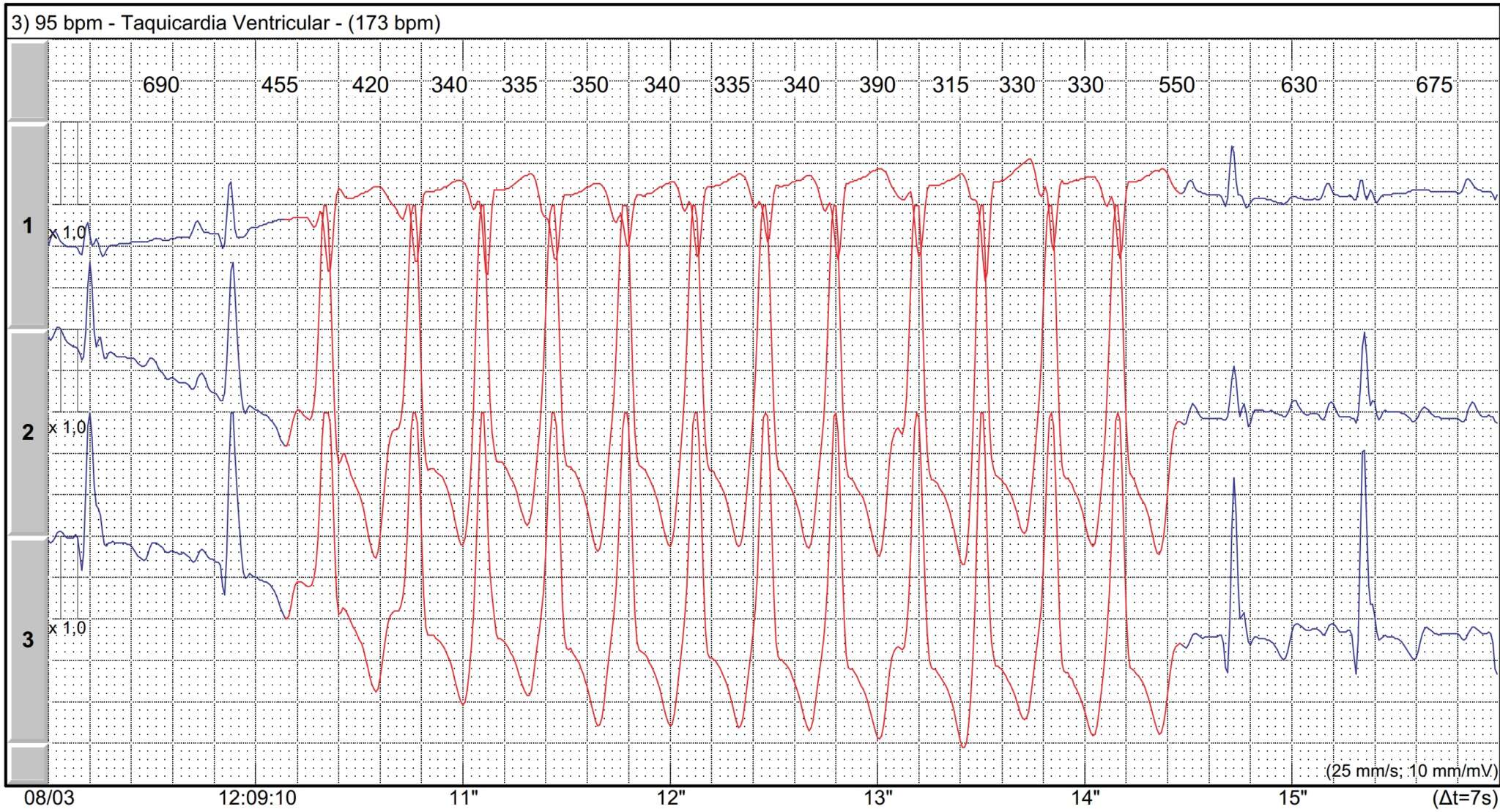 ECG e taquicardia ventricular: características e laudos