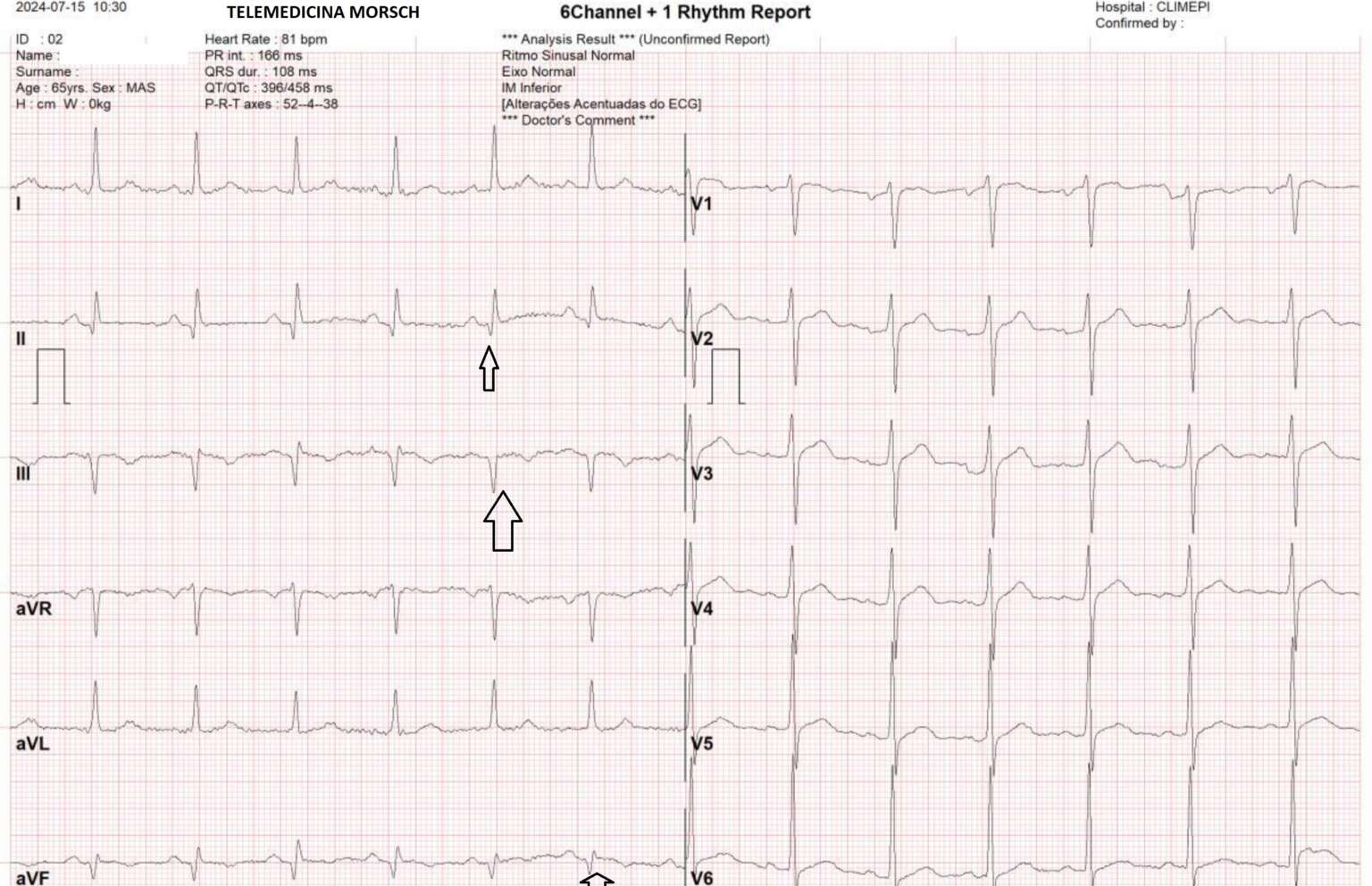 ECG e infarto: como identificar IAM no eletrocardiograma