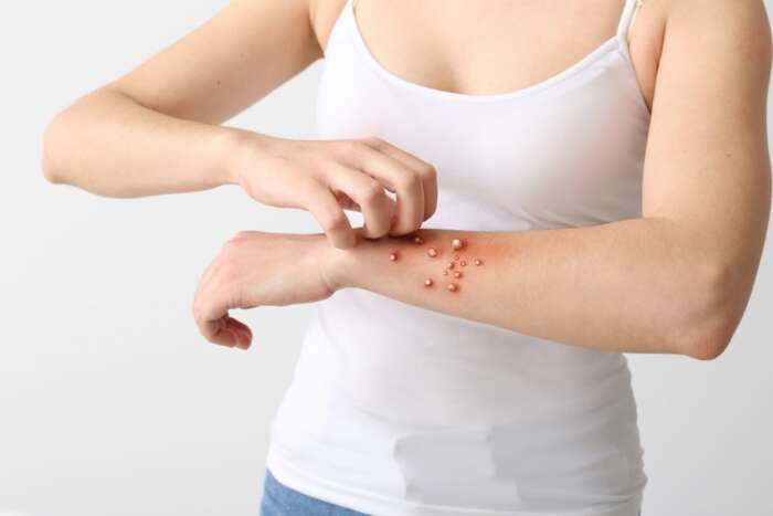 Varíola dos macacos: tratamento, cura e risco de morte