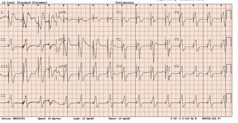 Intoxicação digitálica ECG: como ocorre o diagnóstico?