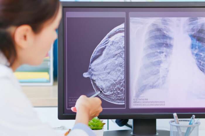 Mamografia com contraste: o que é, como é feita e indicações