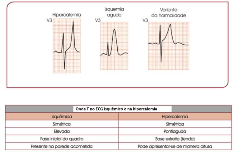 Hipercalemia no ECG: alterações no exame e diagnóstico