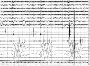 Equipamento para polissonografia: como funciona e custo