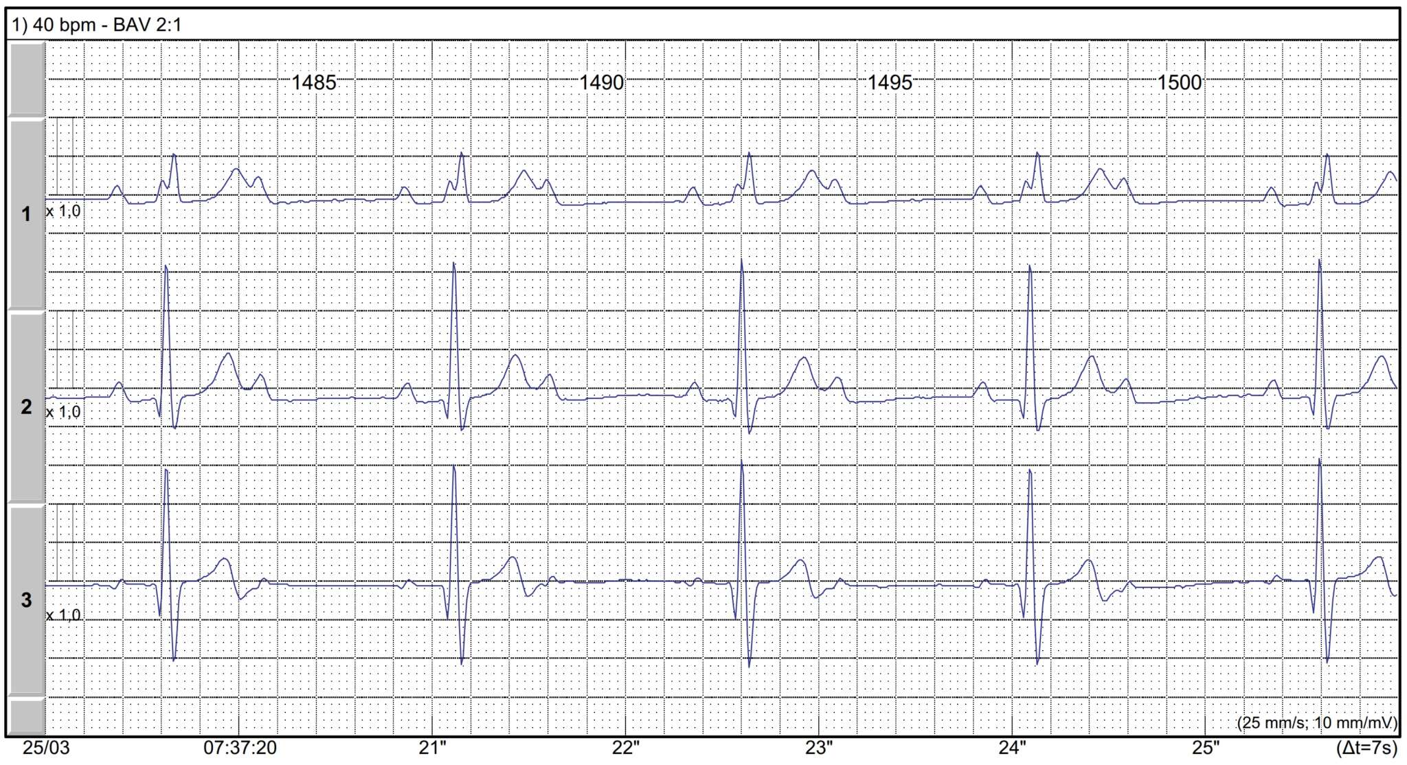 Bloqueio atrioventricular: causas e como diagnosticar