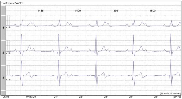 Bloqueio atrioventricular: causas e como diagnosticar