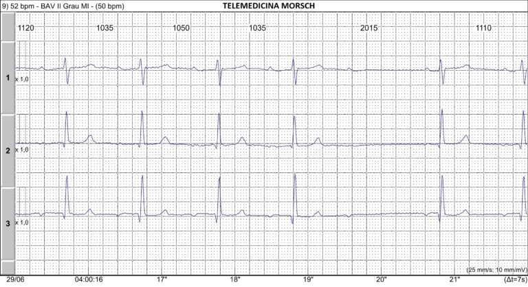 Bloqueio atrioventricular: causas e como diagnosticar