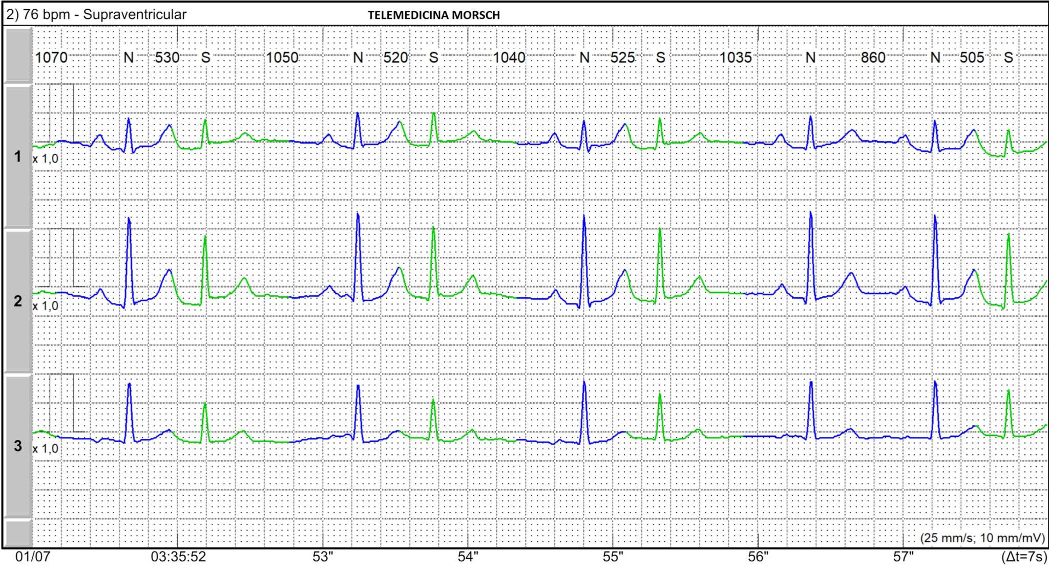 Bloqueio atrioventricular: causas e como diagnosticar