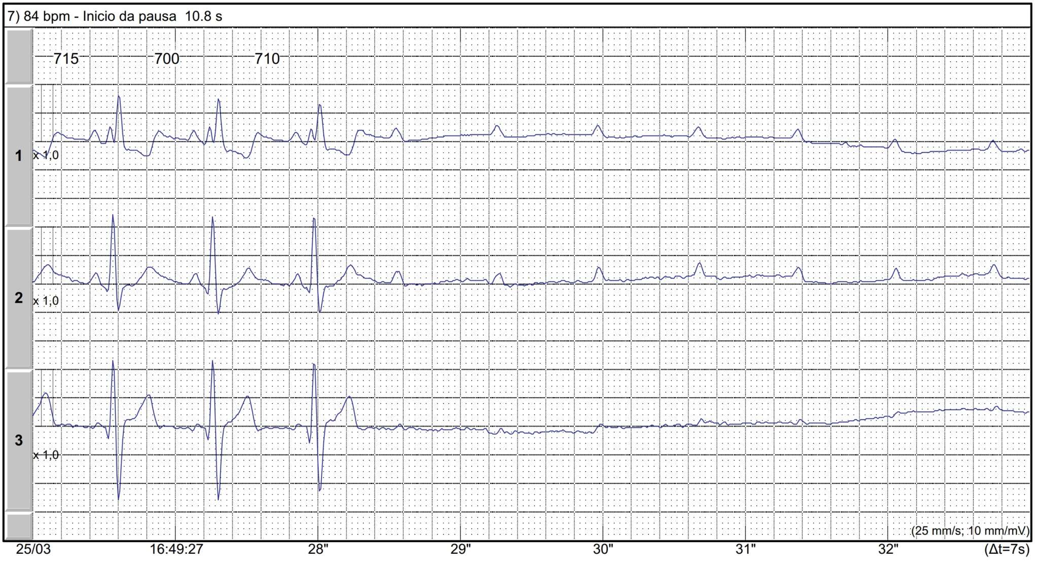 Bloqueio atrioventricular: causas e como diagnosticar