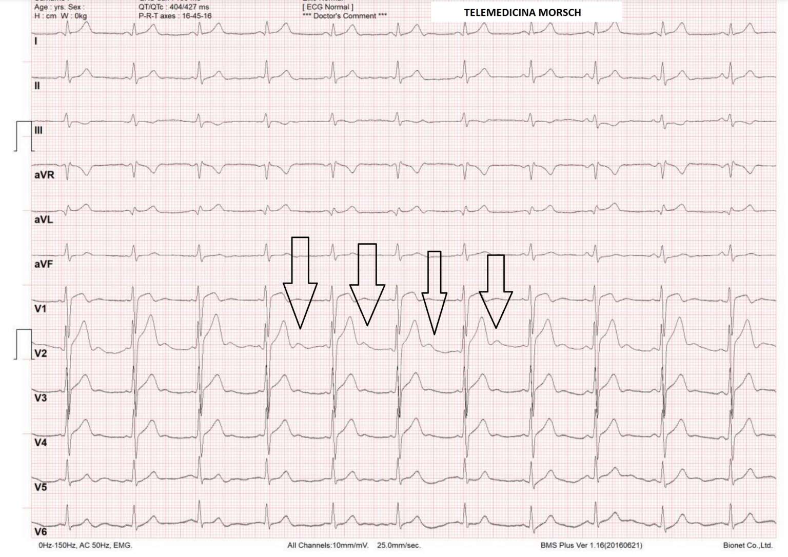 Laudo de eletrocardiograma a distância na telemedicina