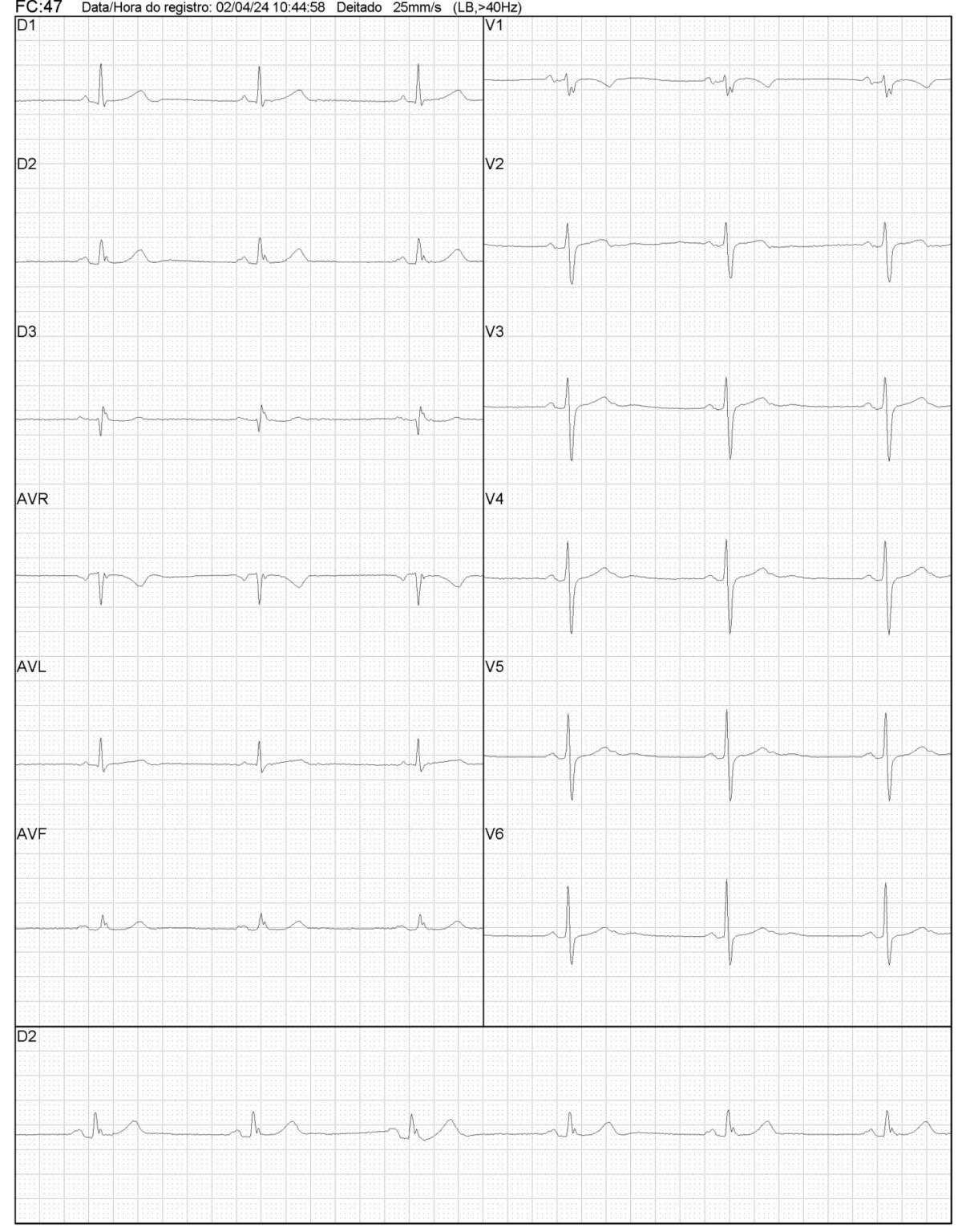 Como interpretar um eletrocardiograma sem erro