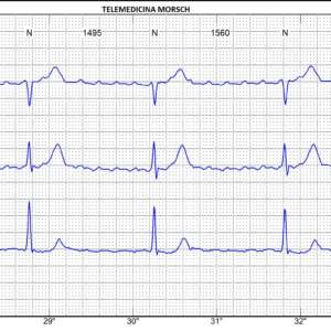 Flutter atrial: o que causa e como corrigir?