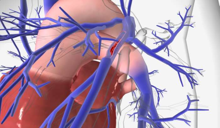 Isquemia miocárdica: quais os sintomas e como tratar?