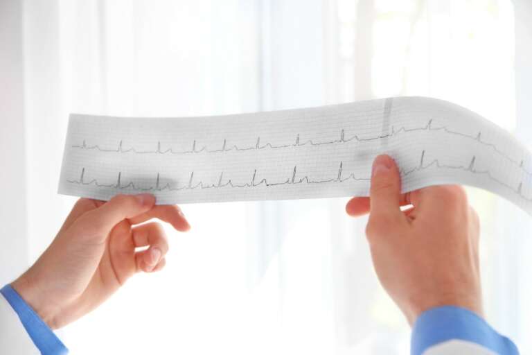 Derivações no ECG: o que são e como interpretar?